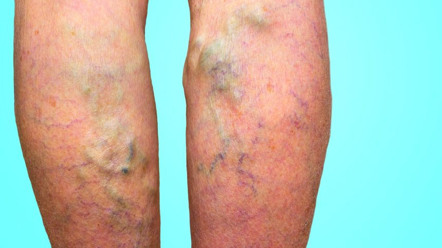 Faire traiter ses veines endommagées | Santé | Journal Métro